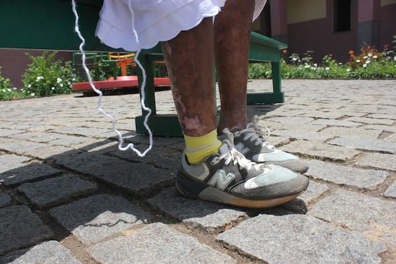 Usa, focolaio di lebbra in Florida: malattia sta diventando endemica ...