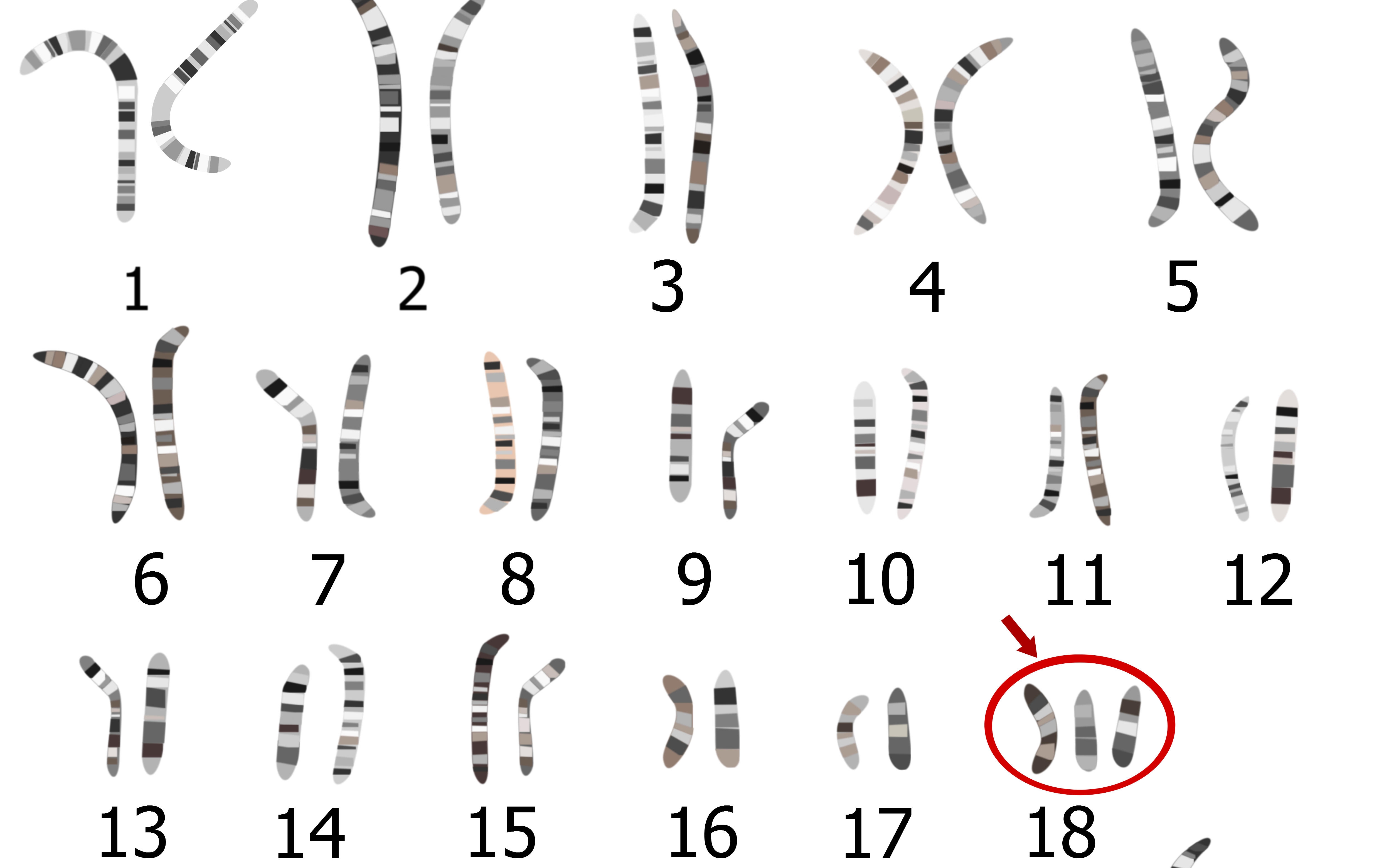 Trisomia 18, cause e sintomi della Sindrome di Edwards | Sky TG24