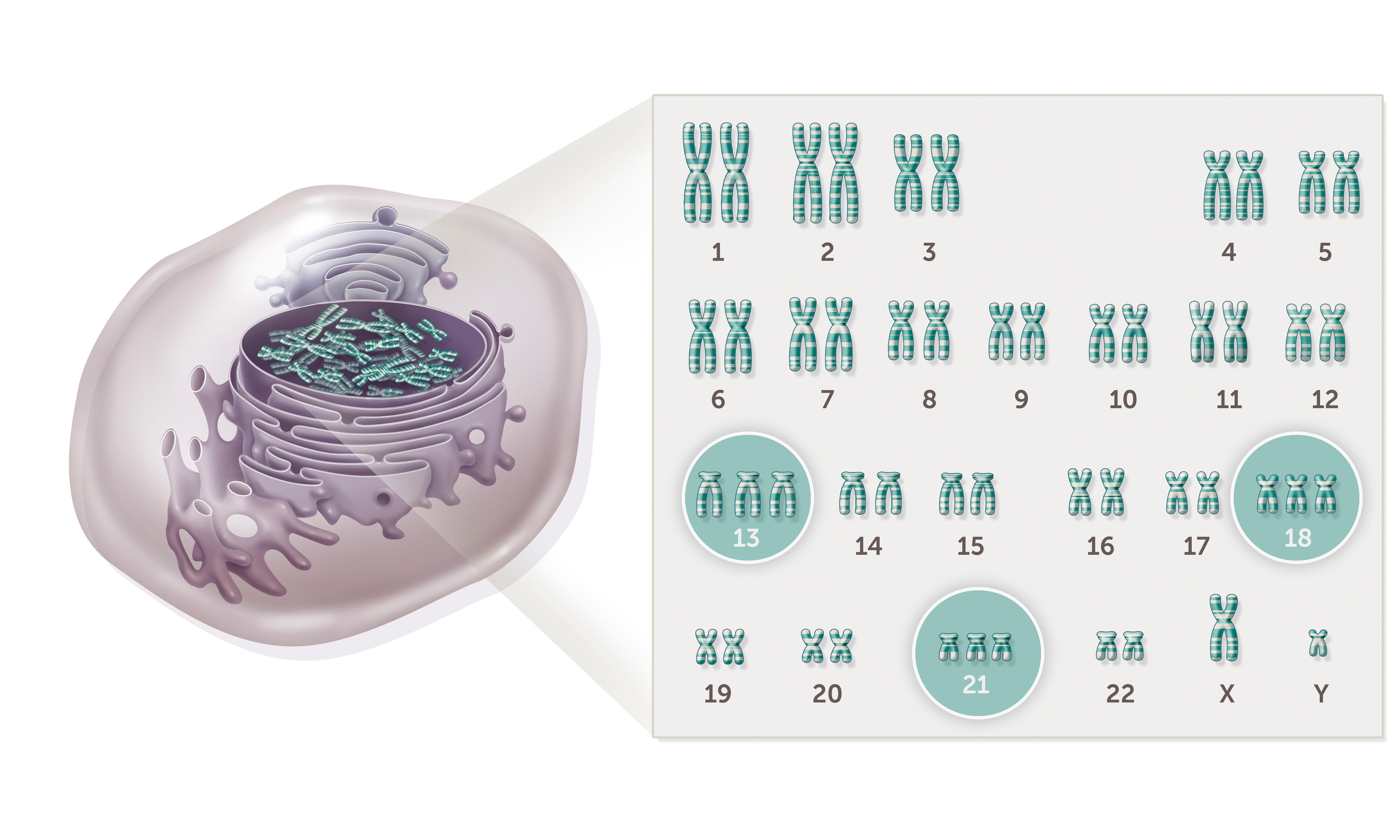 Trisomia 18, cause e sintomi della Sindrome di Edwards | Sky TG24