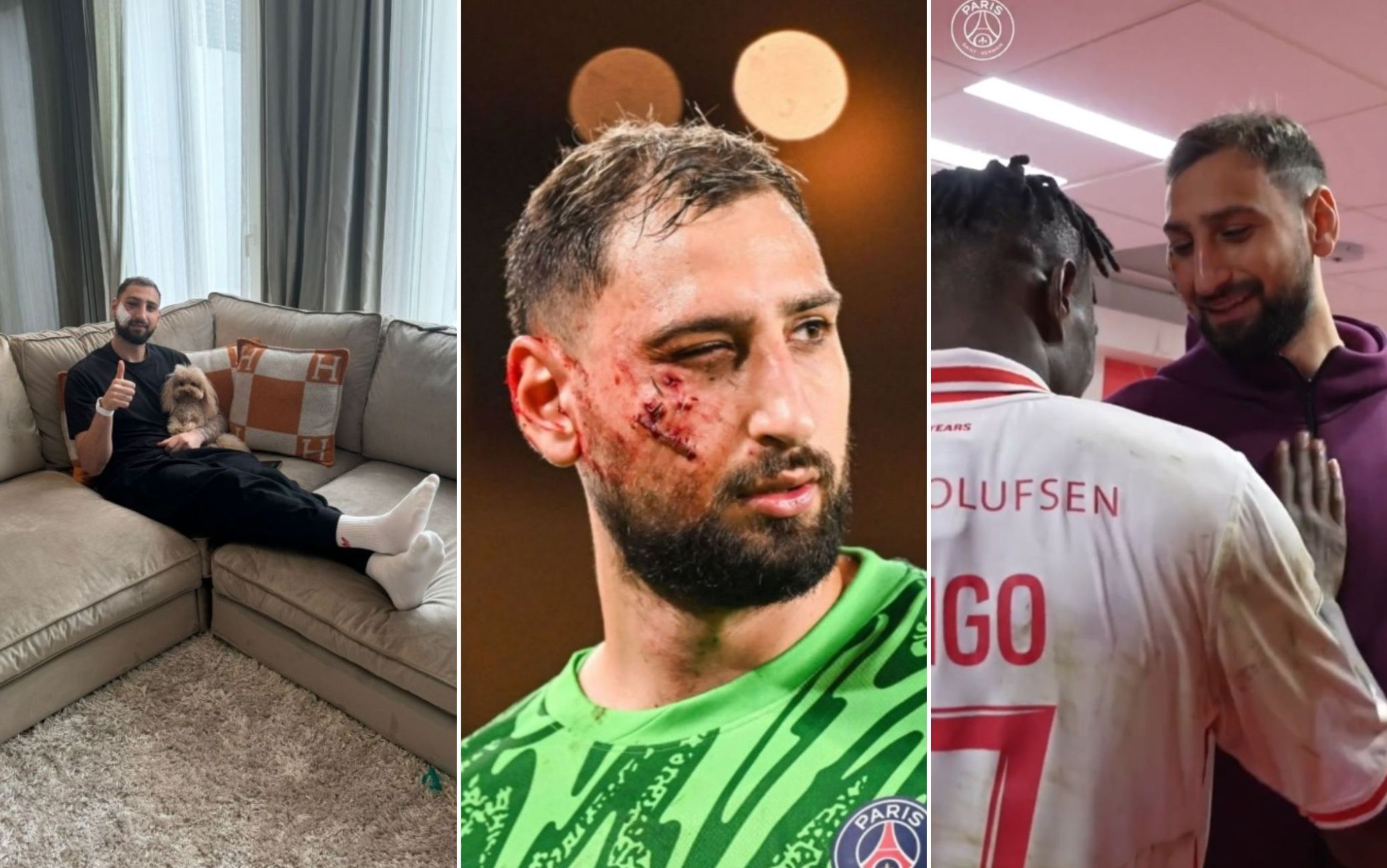 Infortunio Donnarumma in Monaco-Psg dopo un tremendo scontro con Singo ...