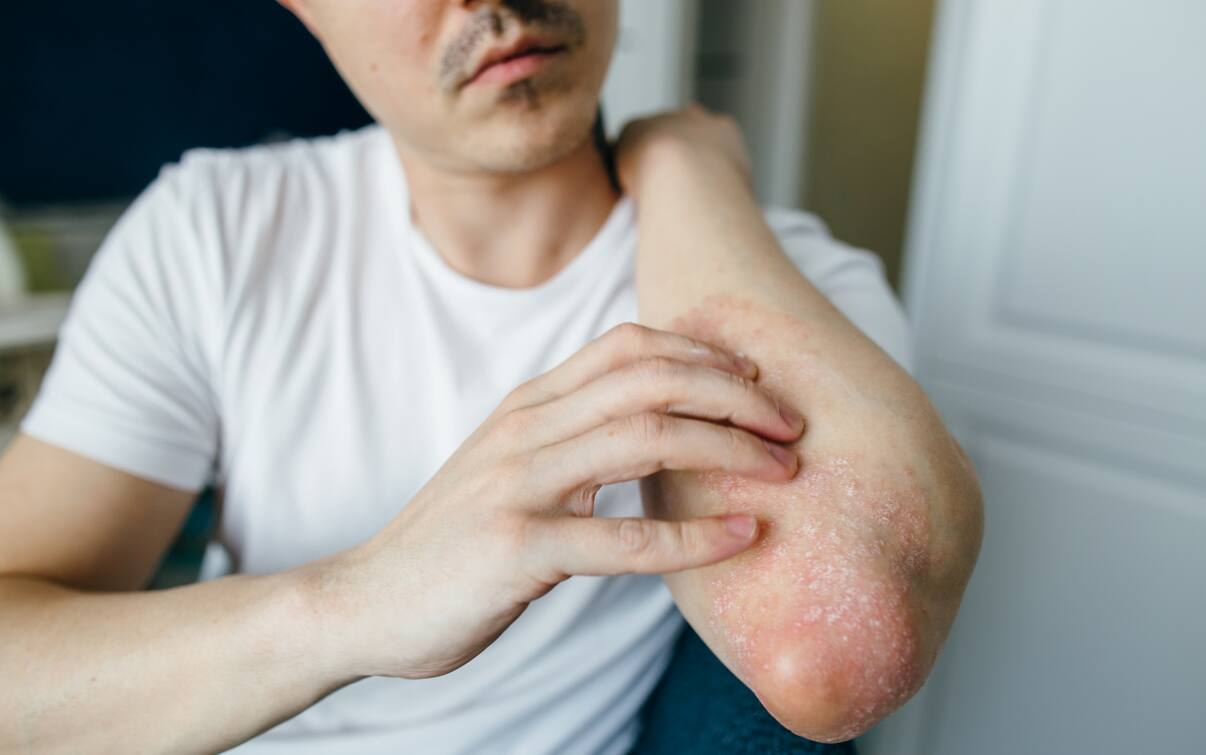 Dermatite atopica grave, bimbi: buoni risultati con farmaco biologico ...